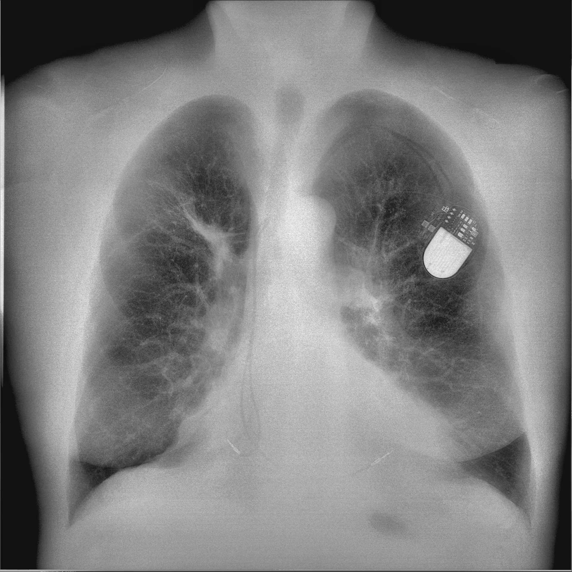Detecting Lung Nodules with Reveal 35C X-Ray