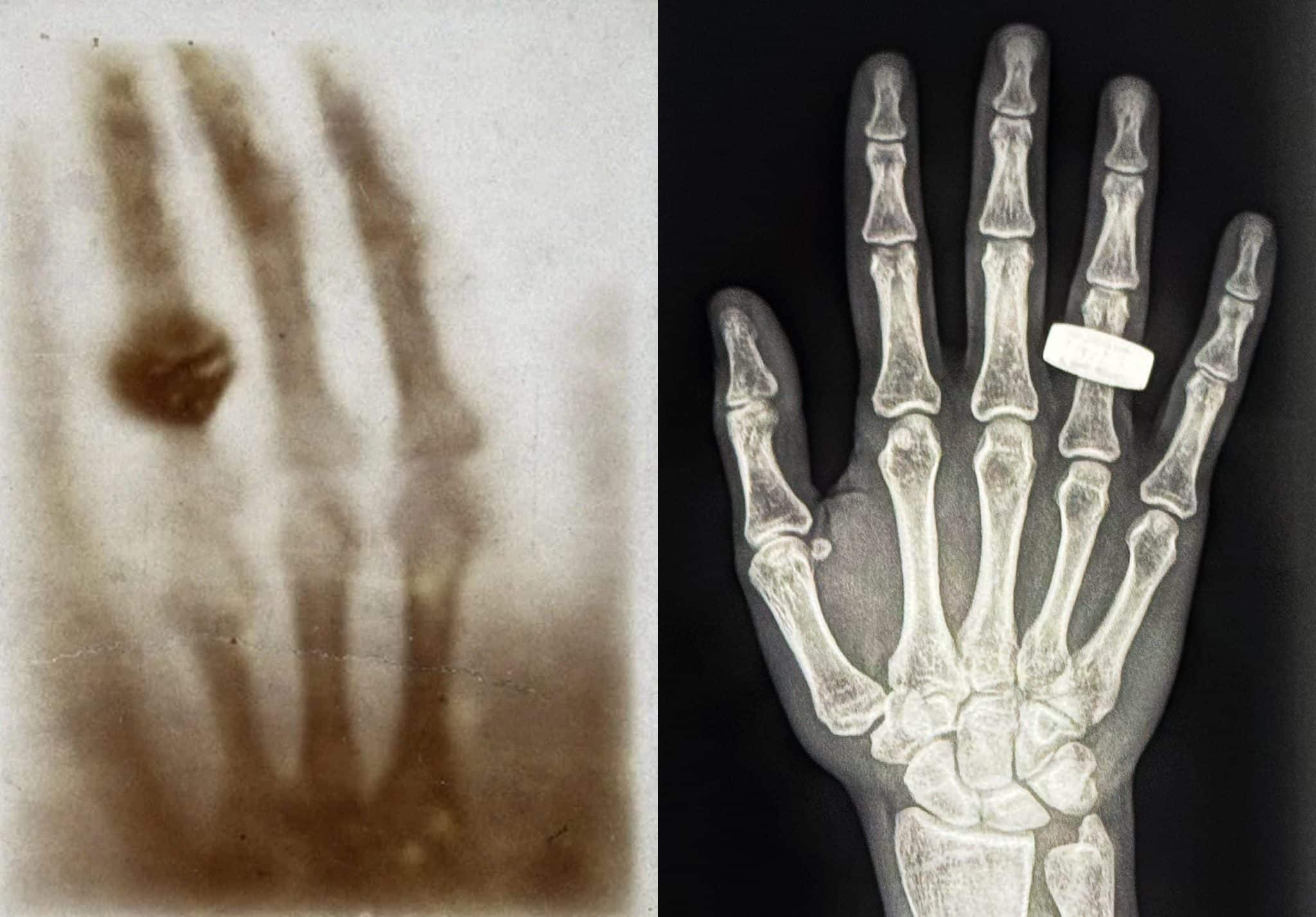 Why the First X-ray in Space is a Hand with a Ring—and Why It Matters