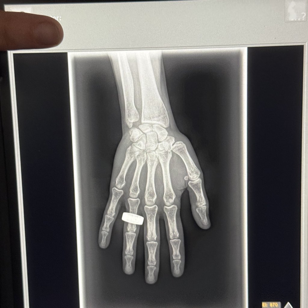 A Historic Image: The First X-ray in Space Is Here