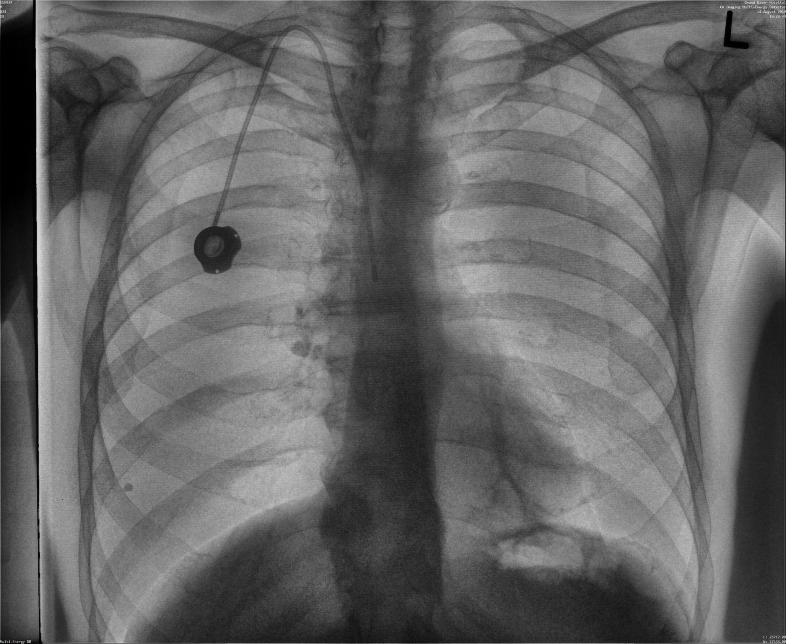 Single-Exposure Dual-Energy X-ray Imaging With Reveal 35C