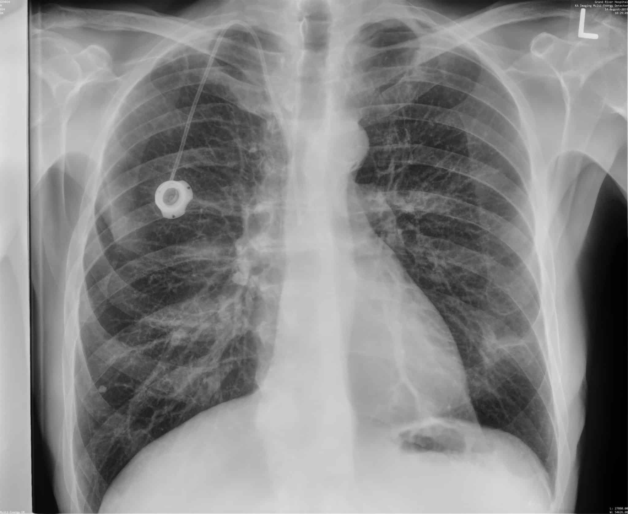 Single-Exposure Dual-Energy X-ray Imaging With Reveal 35C