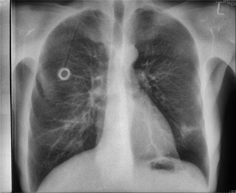 Single-Exposure Dual-Energy X-ray Imaging With Reveal 35C