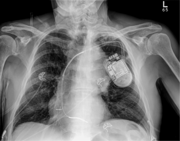 How Dual-Energy Imaging with Reveal 35C Enhances ICU and ED X-ray ...